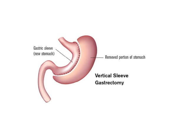 Laparoscopic Sleeve Duodenojejunal Bypass – Gobesity